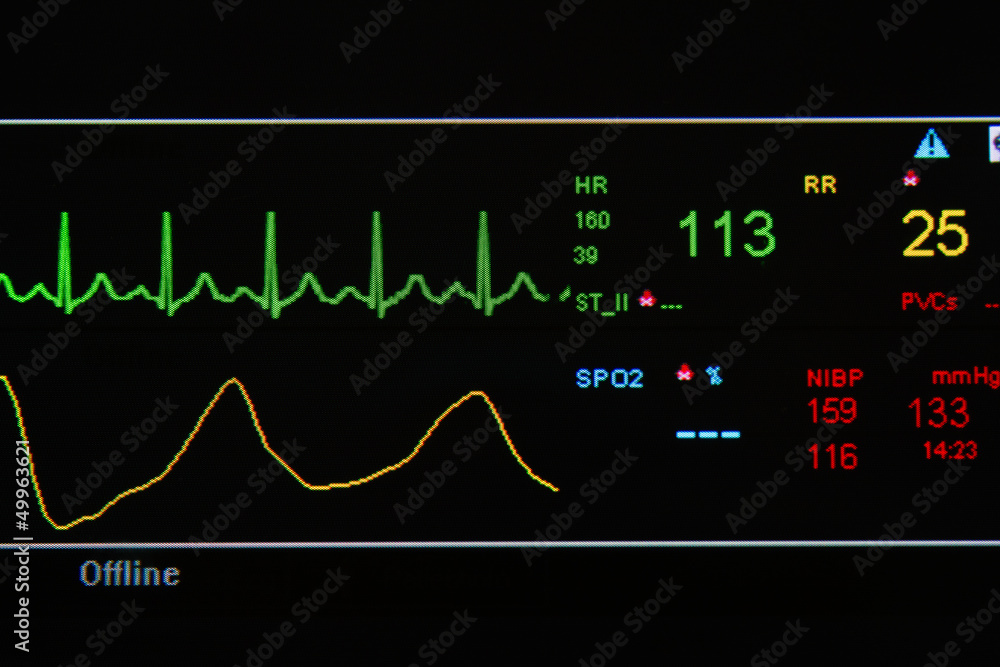 EKG monitor in ICU unit Stock Photo | Adobe Stock