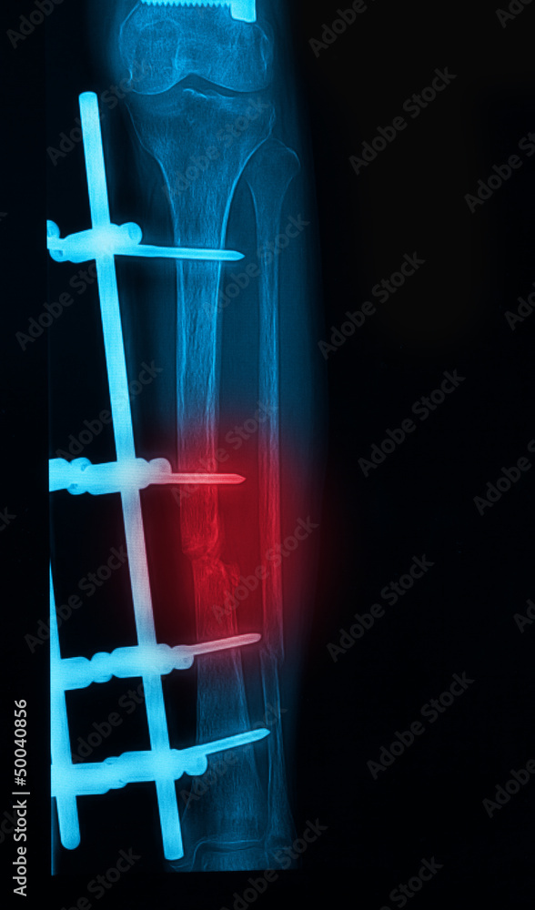 leg x-rays image showing plate and screw external fixation tibia Stock ...
