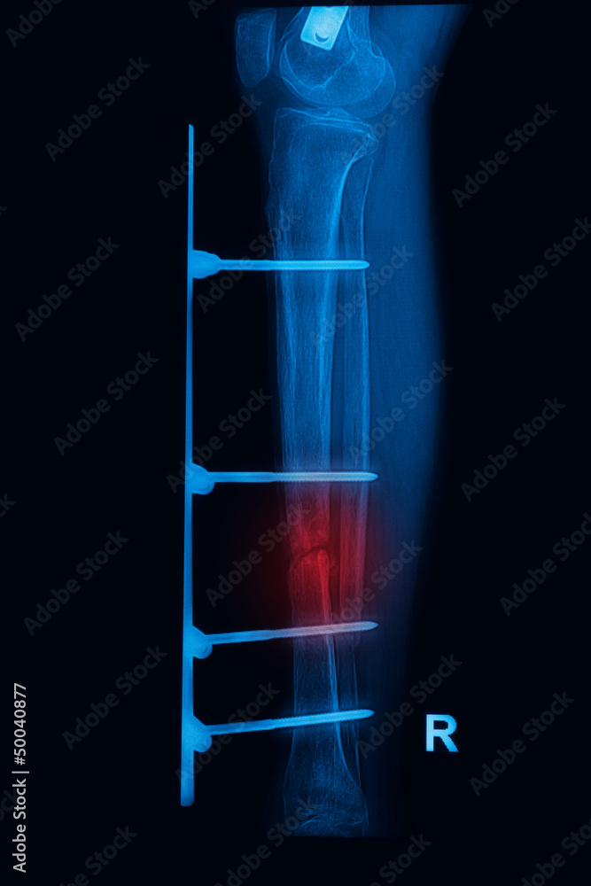 leg x-rays image showing plate and screw external fixation tibia Stock ...