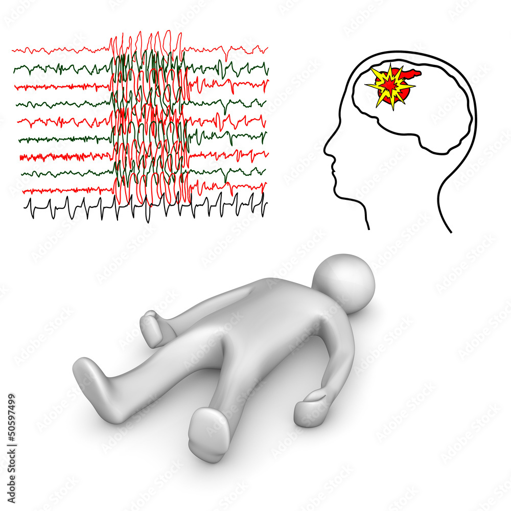 Apoplectic And Epileptic Stroke Stock Illustration | Adobe Stock