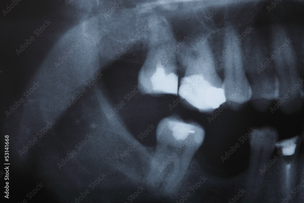 X-ray scan of humans teeth Stock Photo | Adobe Stock