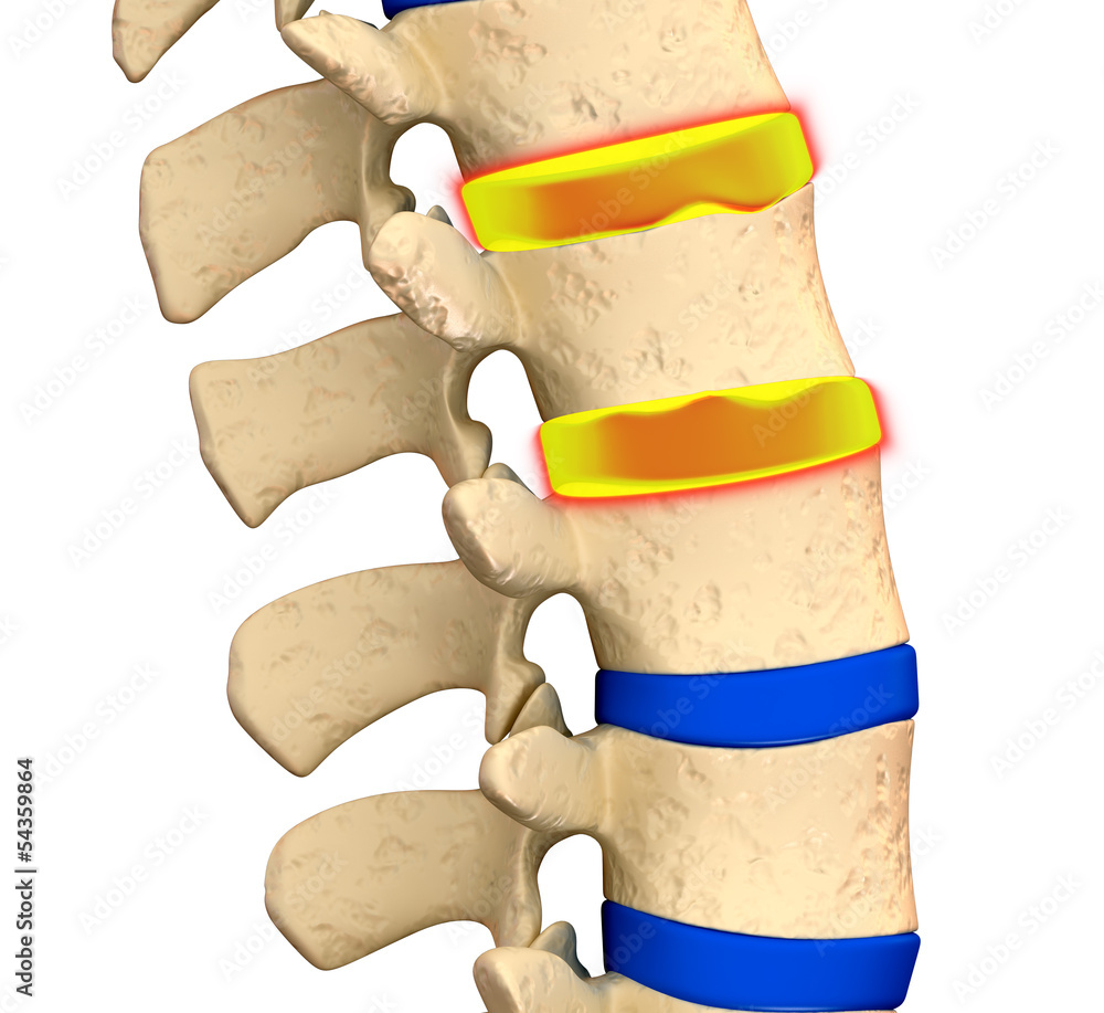 Osteophyte Formation Lumbar Spine