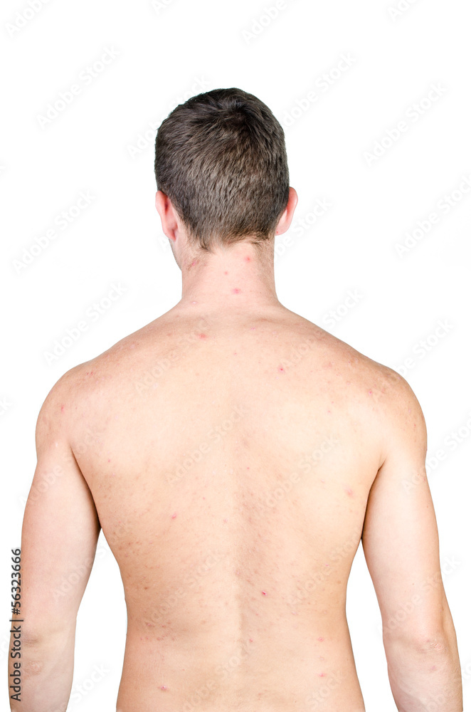 akne auf dem rücken Stock-Foto | Adobe Stock