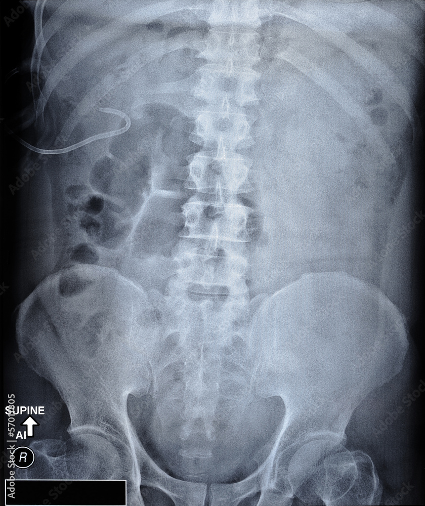 X ray film of kidney stones with ureteric stent Stock Photo | Adobe Stock