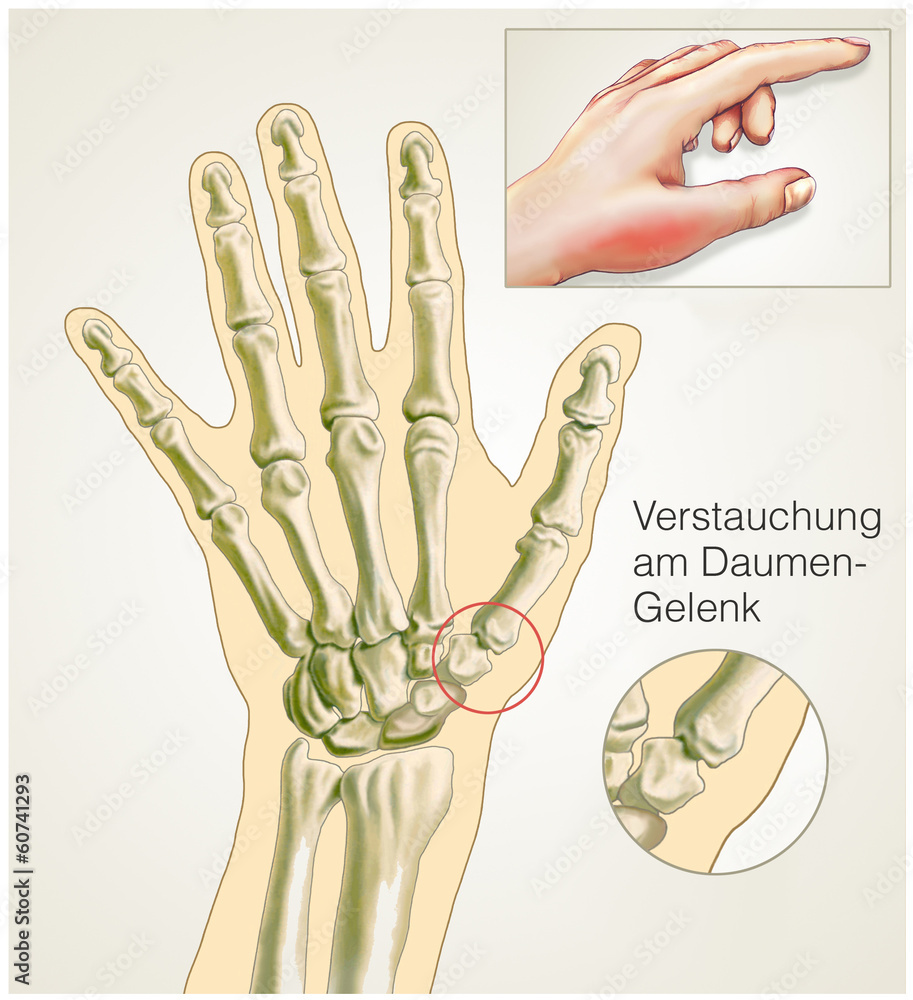 Verstauchung am Daumengelenk Stock-Illustration | Adobe Stock