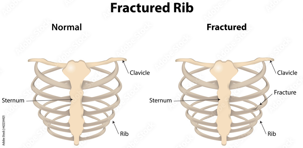 Fractured Rib Labeled Diagram Stock Illustration | Adobe Stock