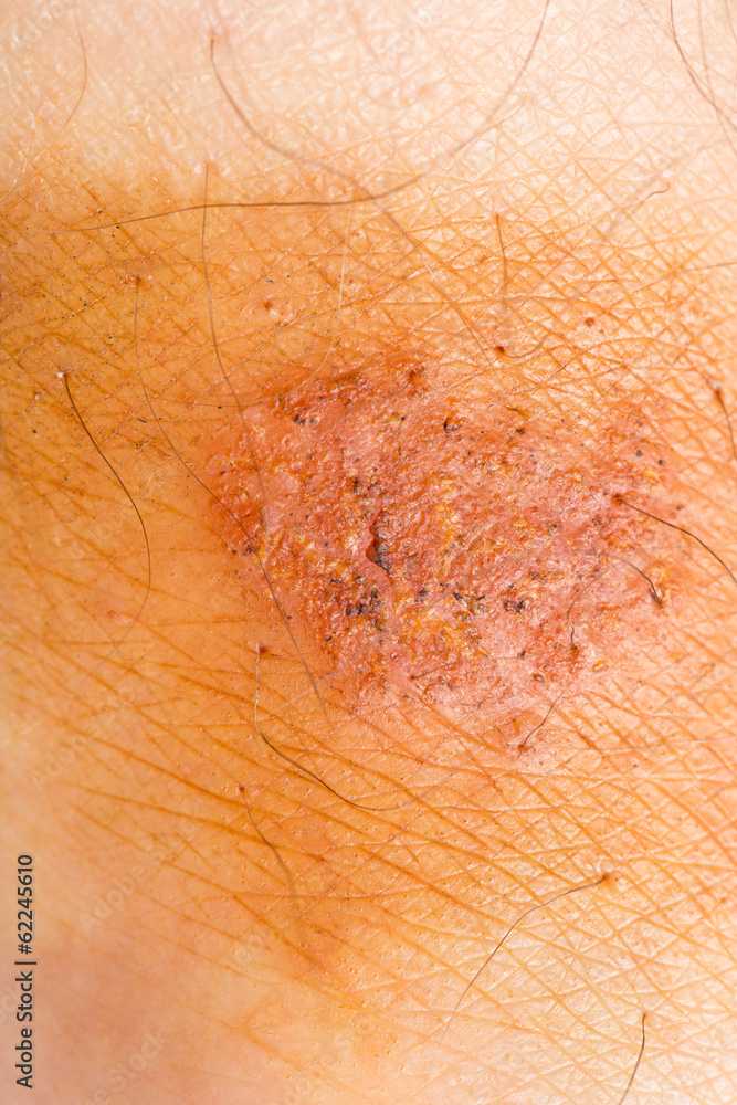 Sore On The Skin Macro Stock Photo Adobe Stock sore-on-the-skin-macro-stock-photo-adobe-stock