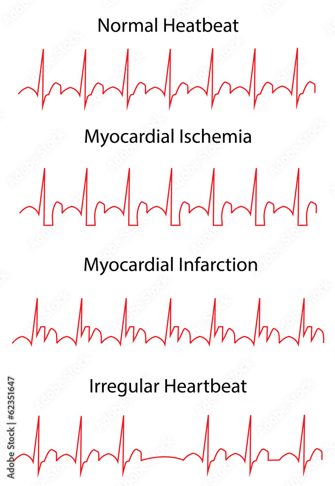 EKG Traces of Normal and Pathologies Stock Illustration | Adobe Stock