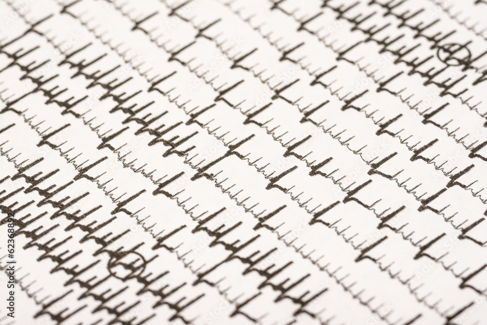 Extrasystoles And Atrial Fibrillation On Electrocardiogram Stock Photo ...