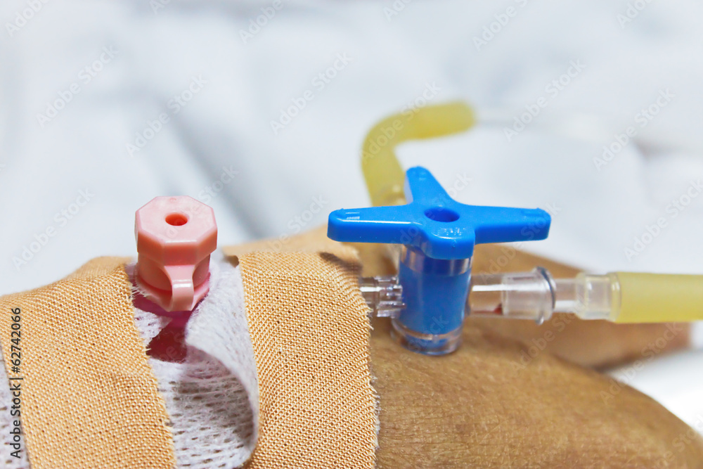 Injection inlet and infusion valve Stock Photo | Adobe Stock