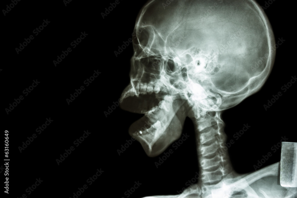 X-ray asian skull and open mouth Stock Photo | Adobe Stock
