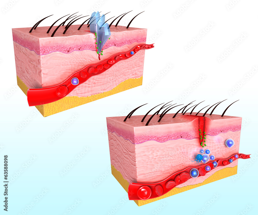 immune response system of human skin in two step Stock Illustration ...
