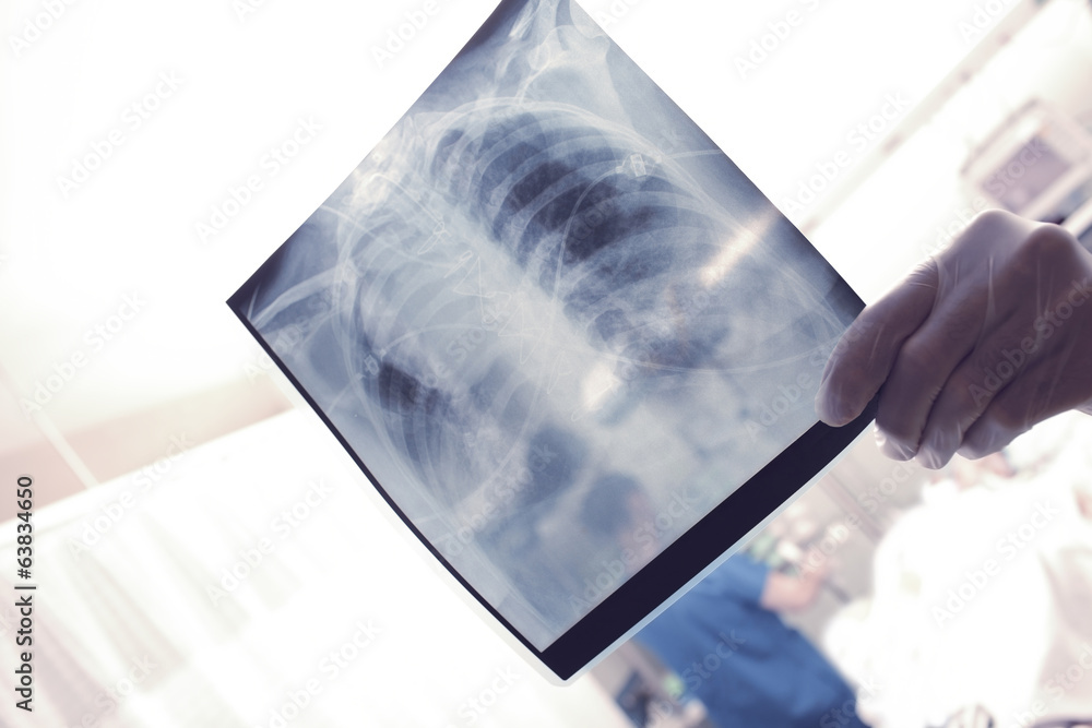 Chest X-ray study Stock Photo | Adobe Stock