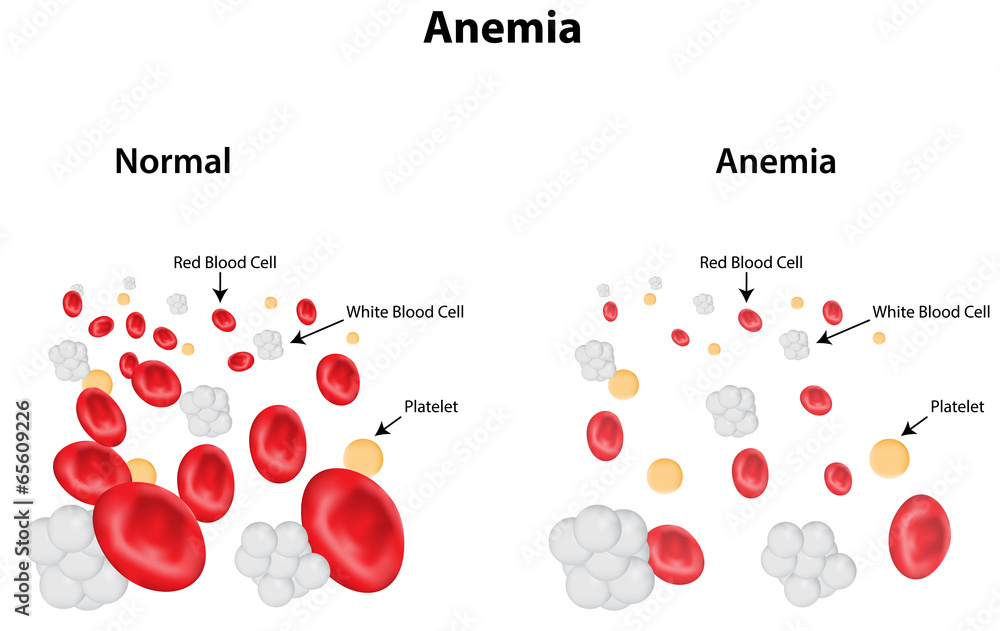 Anemia Labeled Diagram Stock Vector | Adobe Stock