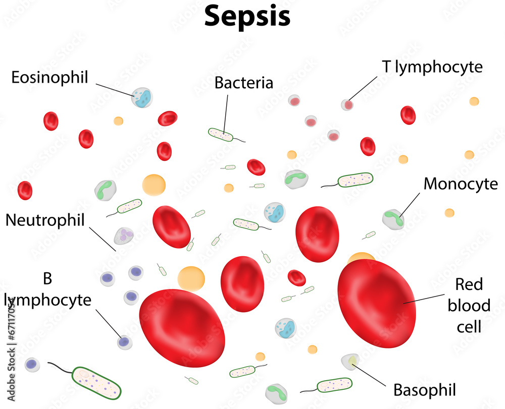 Labeled Sepsis DIagram Stock Illustration | Adobe Stock