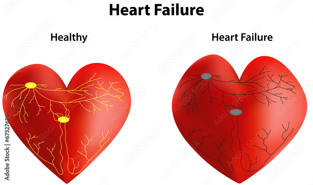 Heart Failure Diagram Stock Vector | Adobe Stock