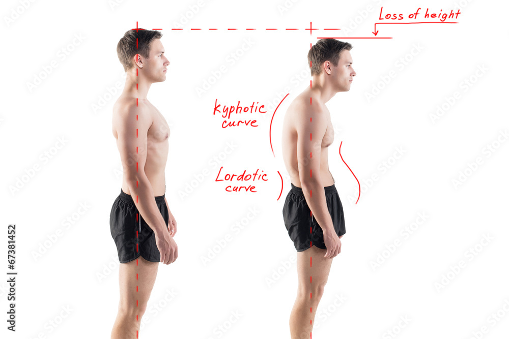 Man with impaired posture position defect scoliosis and ideal Stock ...