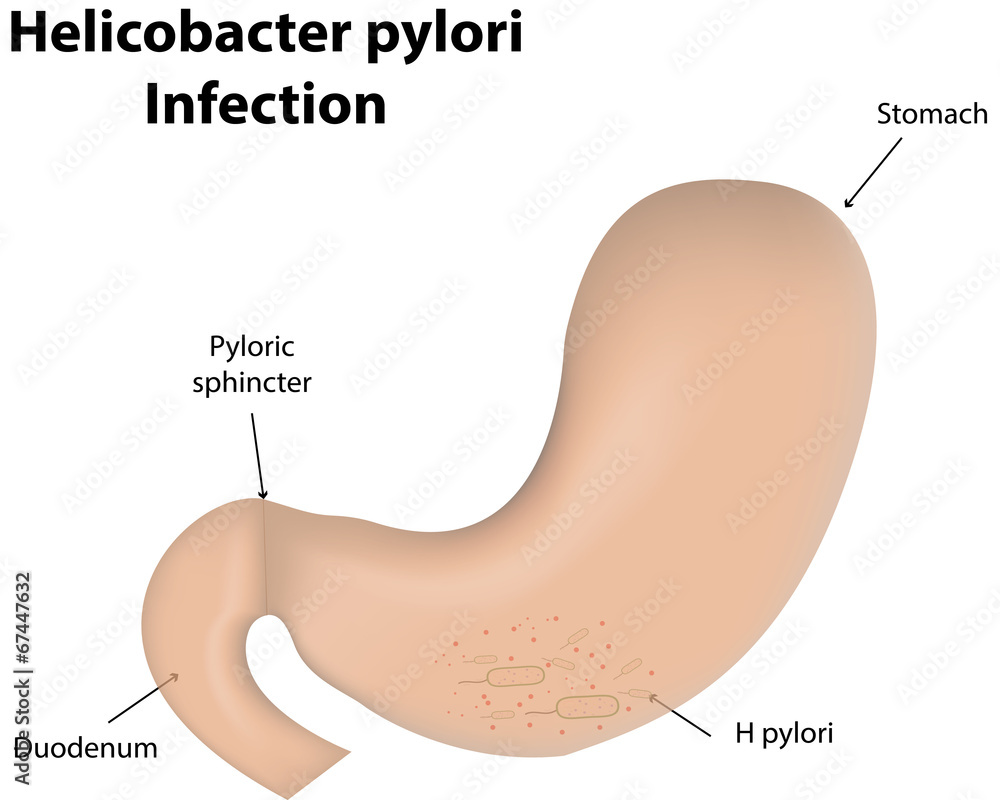 Helicobacter Pylori Infection vector de Stock | Adobe Stock