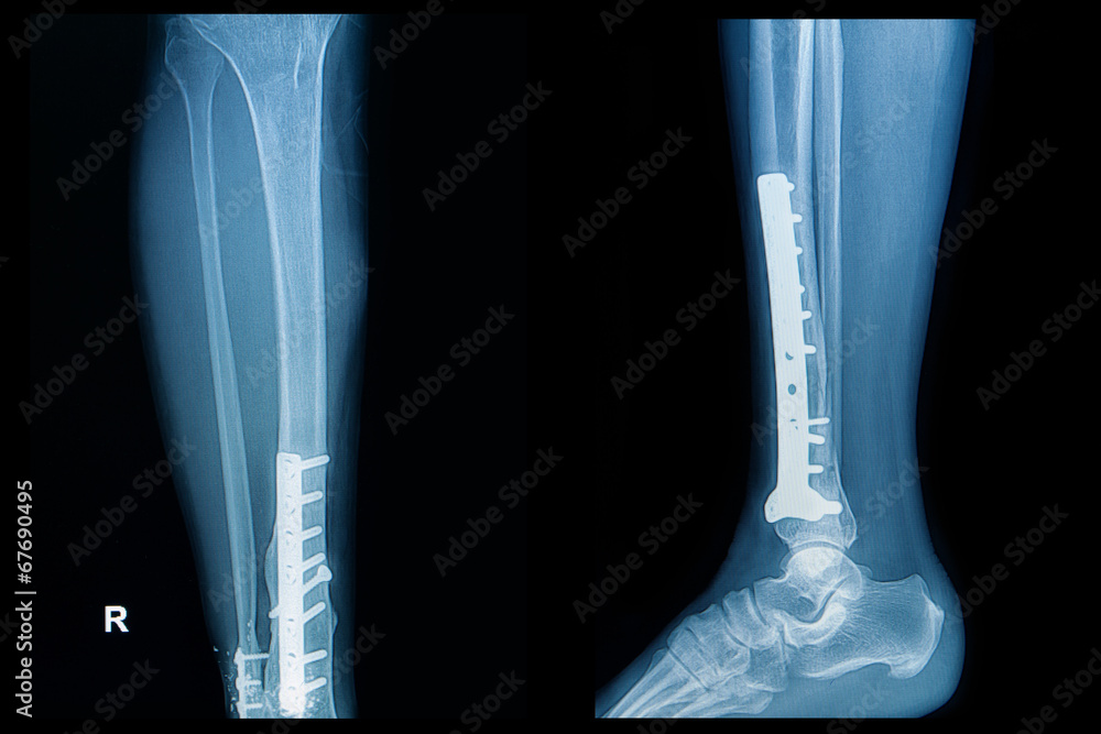 x-ray image of fracture leg (tibia )with implant Stock Photo | Adobe Stock