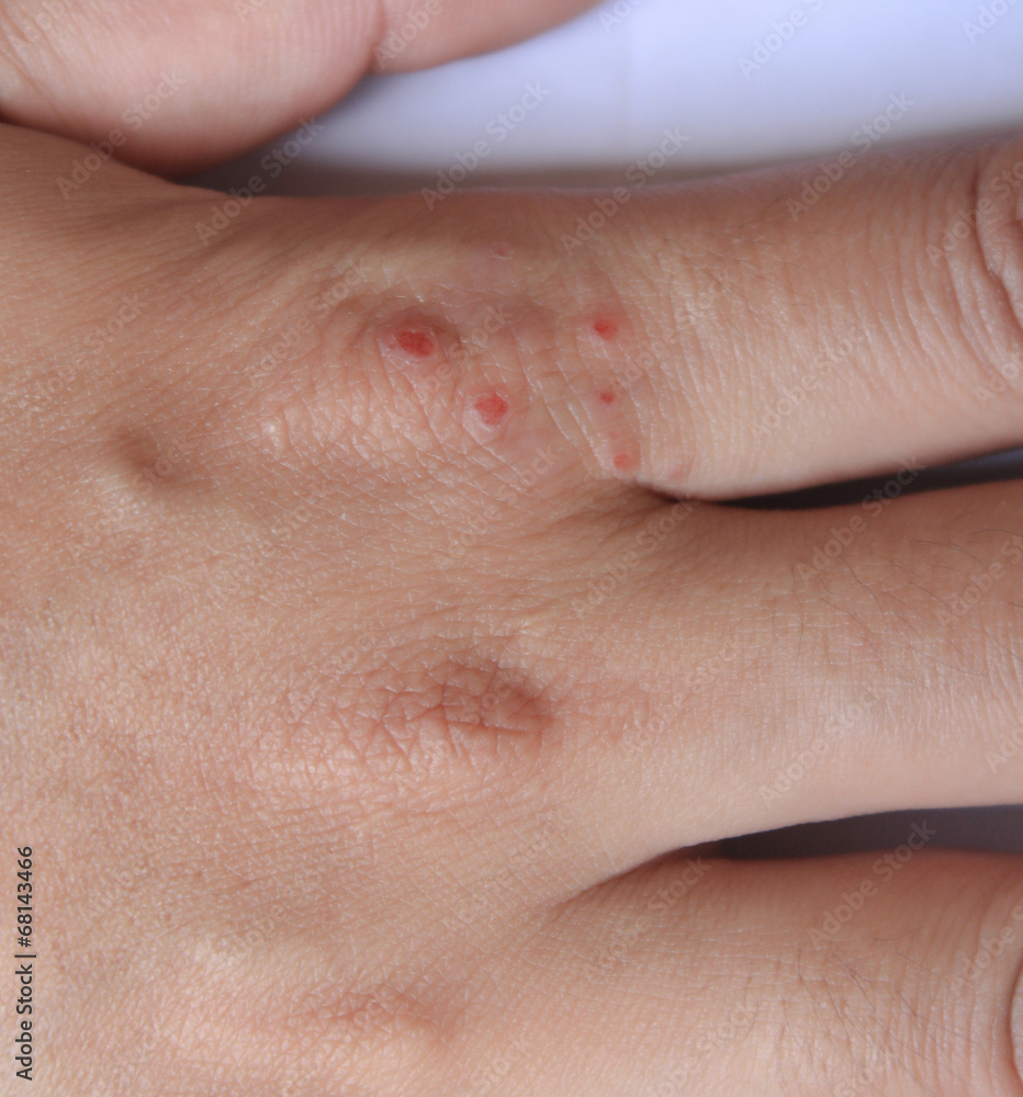 Itchy Skin Rash On Hands Itchy Skin Rash On Hands