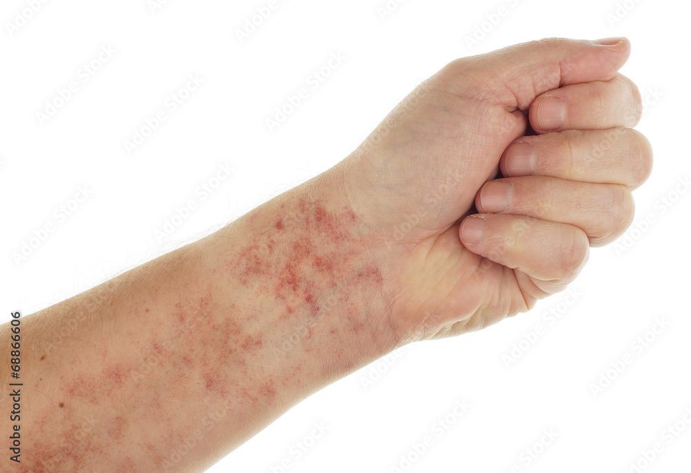 Forearm showing Capillaritis by Leaking Capillaries Stock Photo | Adobe ...