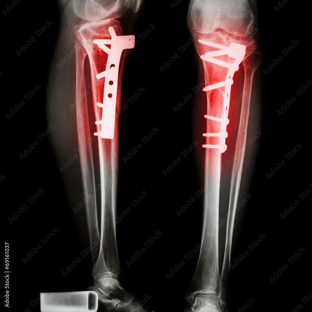 fracture tibia(leg bone). It was operated and internal fixed by Stock ...