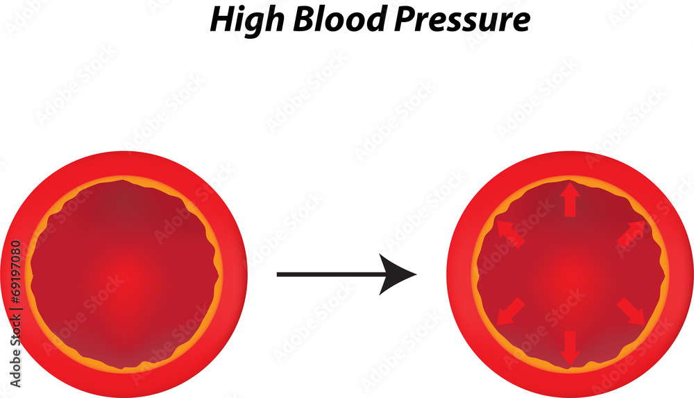 High Blood Pressure Stock Illustration | Adobe Stock
