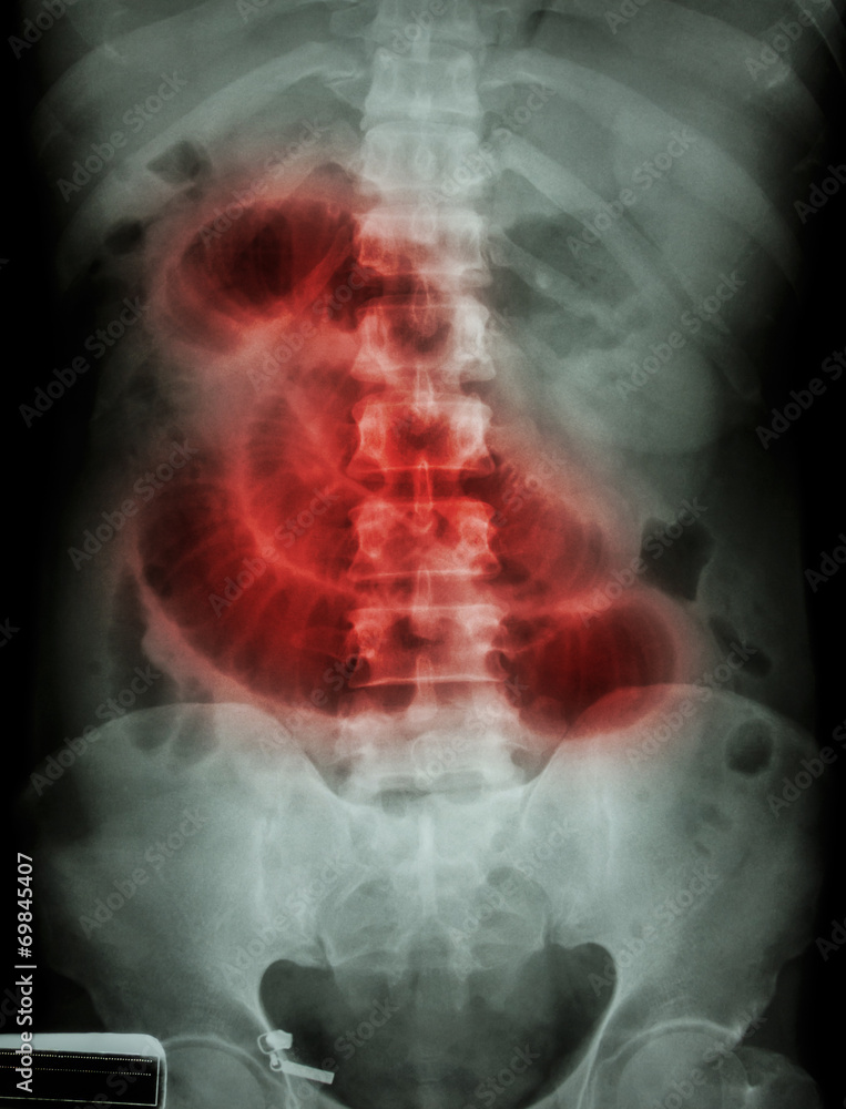 "Small intestine obstruction" Film X-ray abdomen supine Stock Photo ...