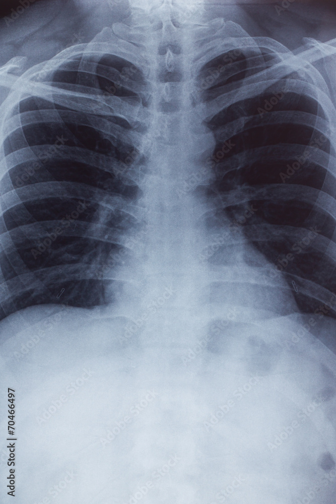 X-ray image of chest Stock Photo | Adobe Stock
