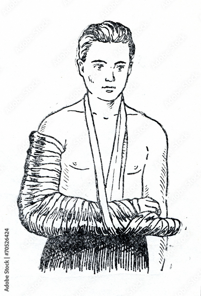 Emergency splinting of forearm fracture Stock Illustration | Adobe Stock