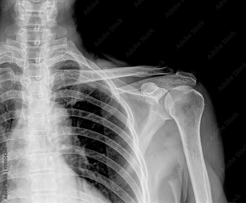 X-ray of shoulder joint Stock Photo | Adobe Stock