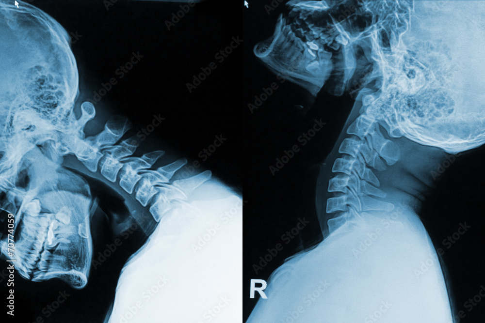 x-ray image of neck show neck pain in flex and exten position Stock ...