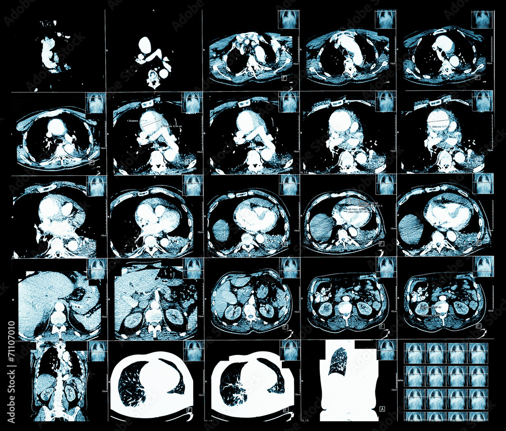 Computed tomography of thoracic segment Stock Photo | Adobe Stock