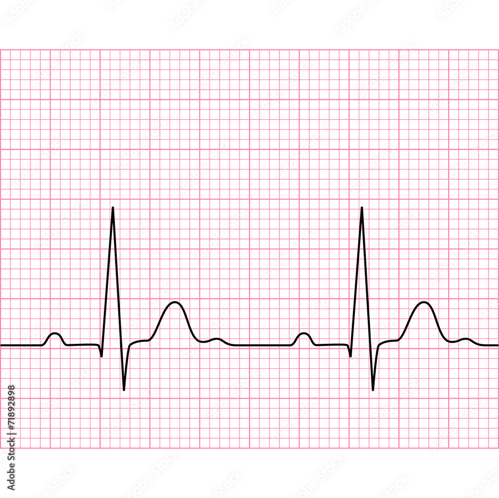 Illustration of medical electrocardiogram - ECG on chart paper Stock ...