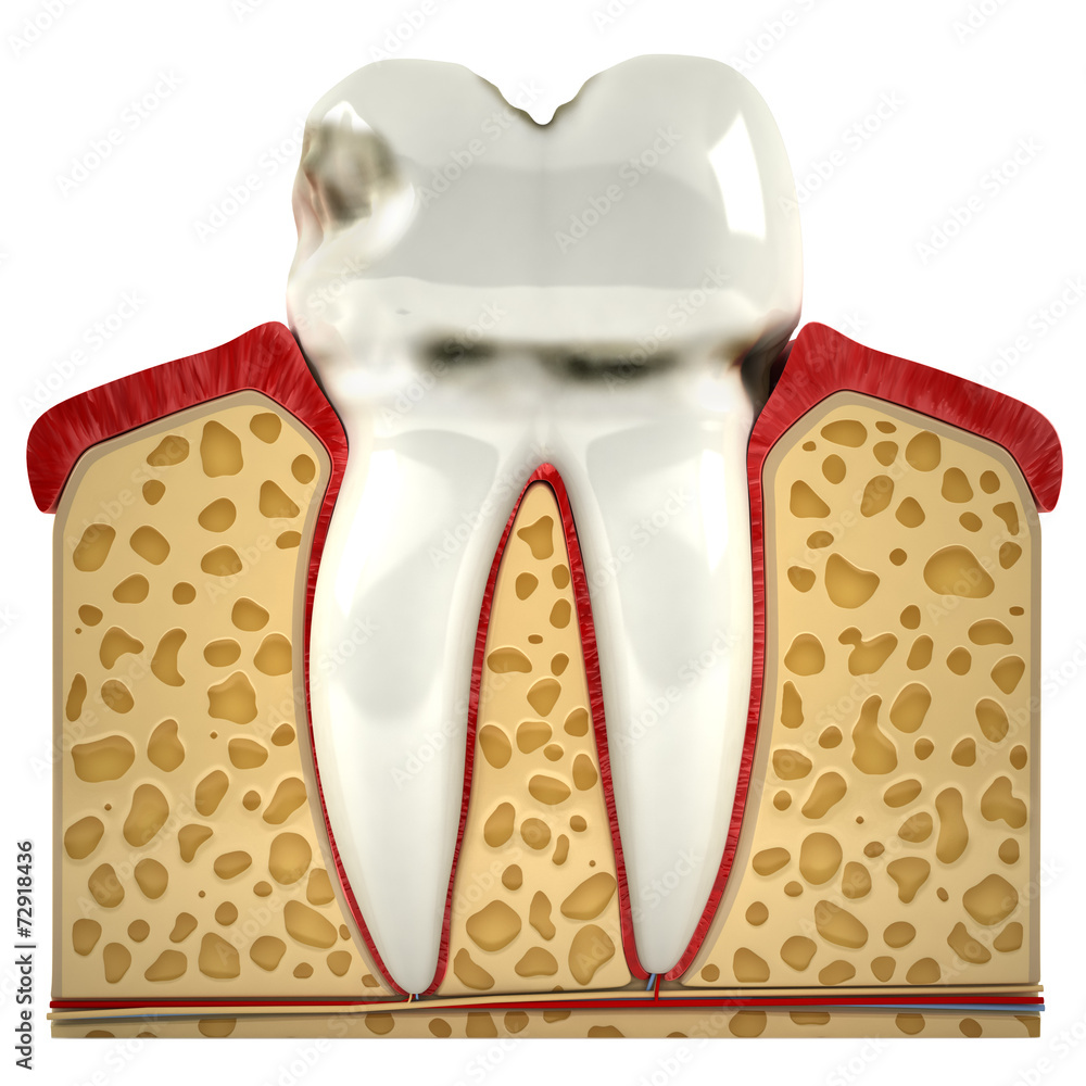 Human tooth, with types of caries (3d model) Stock Illustration | Adobe ...