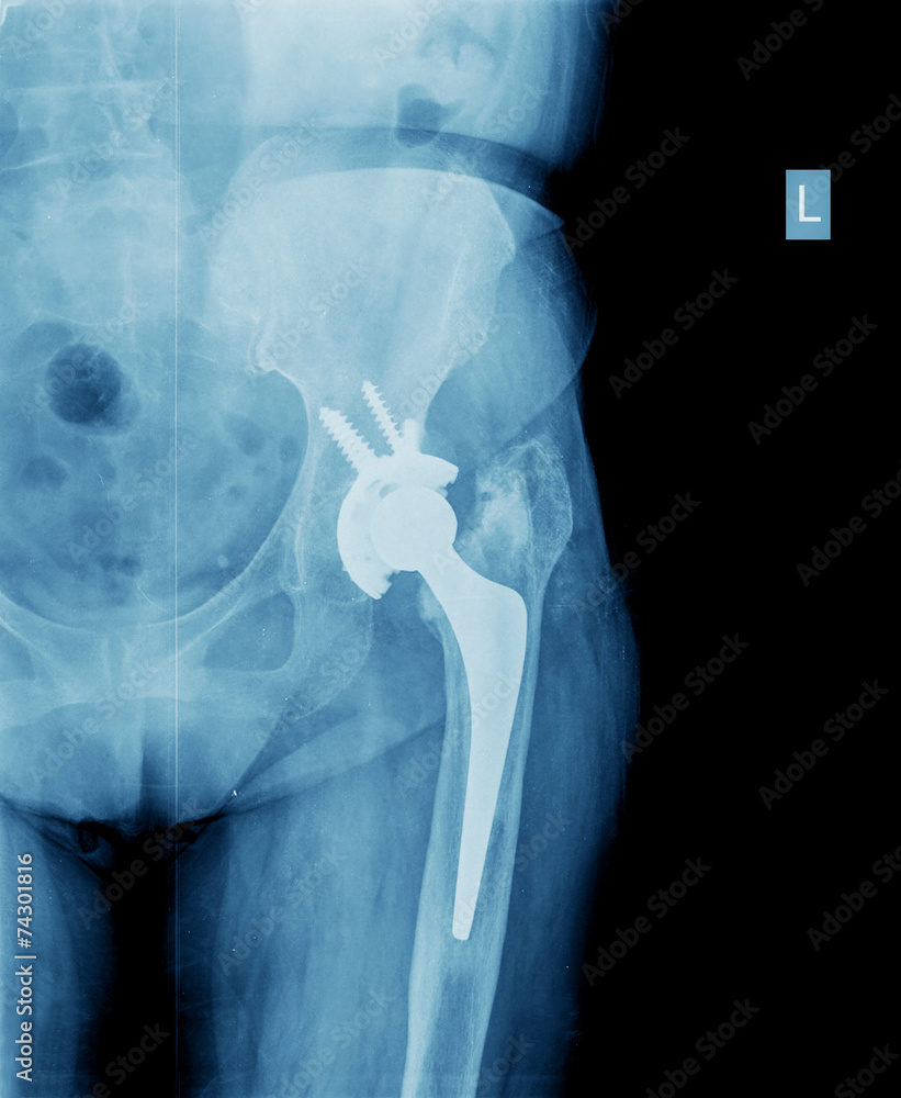X-ray of the hip prosthesis Stock Photo | Adobe Stock