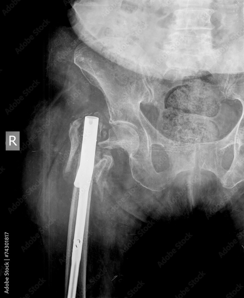 X-ray of the hip prosthesis Stock Photo | Adobe Stock