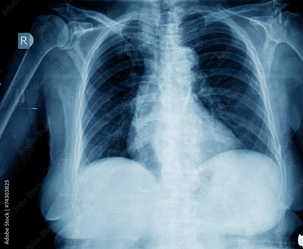 x-ray chest Stock Photo | Adobe Stock