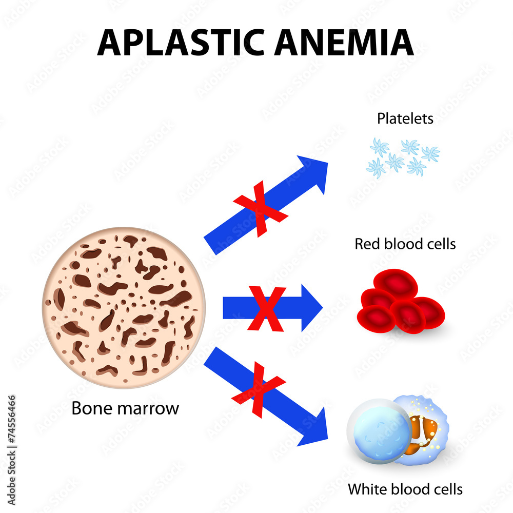 Aplastic Anemia Stock Vector Adobe Stock