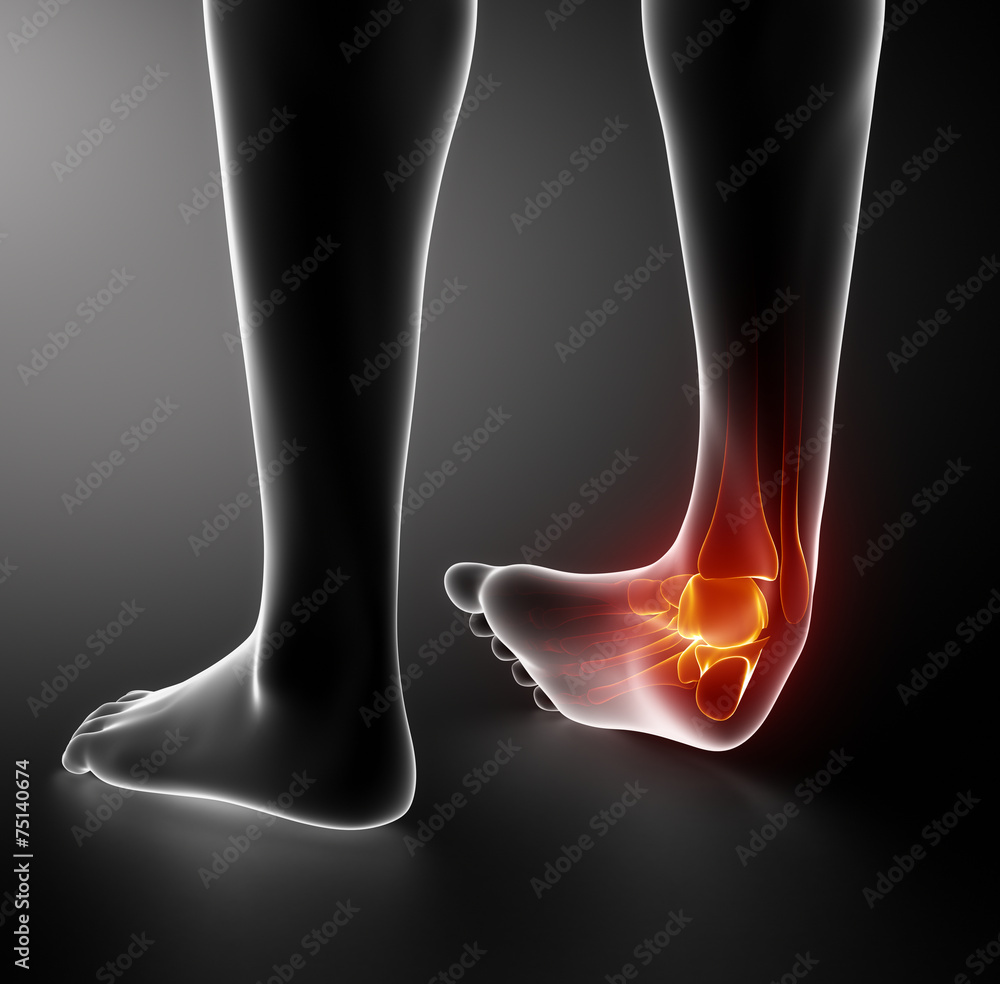 Sprained ankle black x-ray Stock Illustration | Adobe Stock
