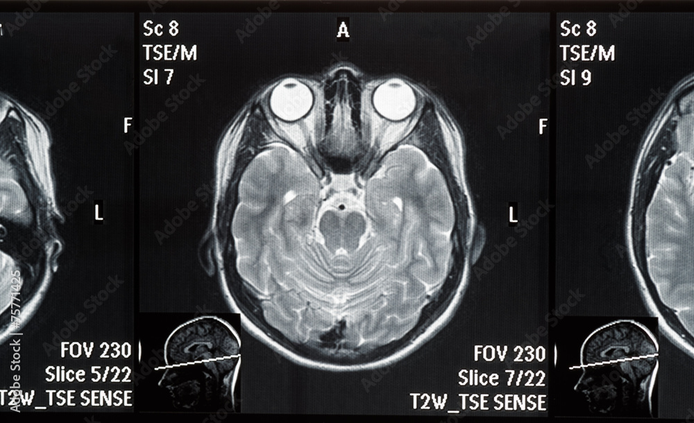Foto de Real brain MRI slide of a woman. Patient's and clinic's names ...