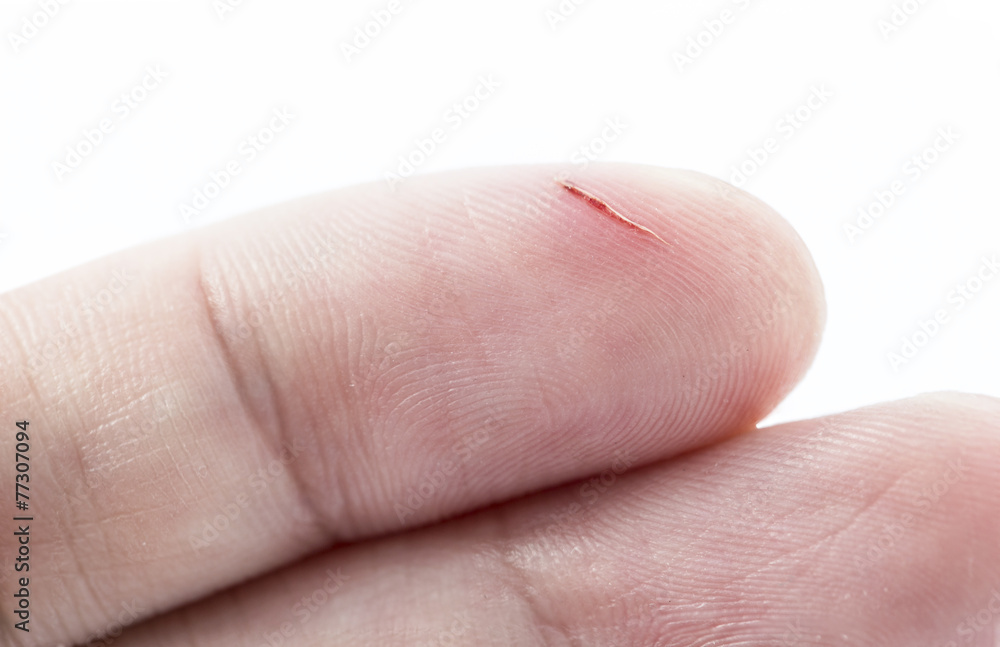 incision wound on finger with white background Stock Photo | Adobe Stock