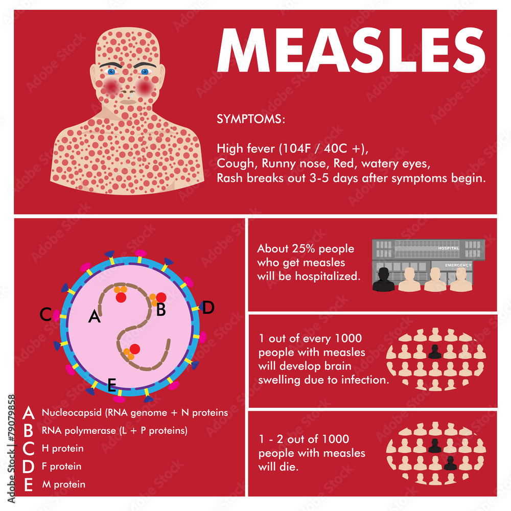 Infographic Measles