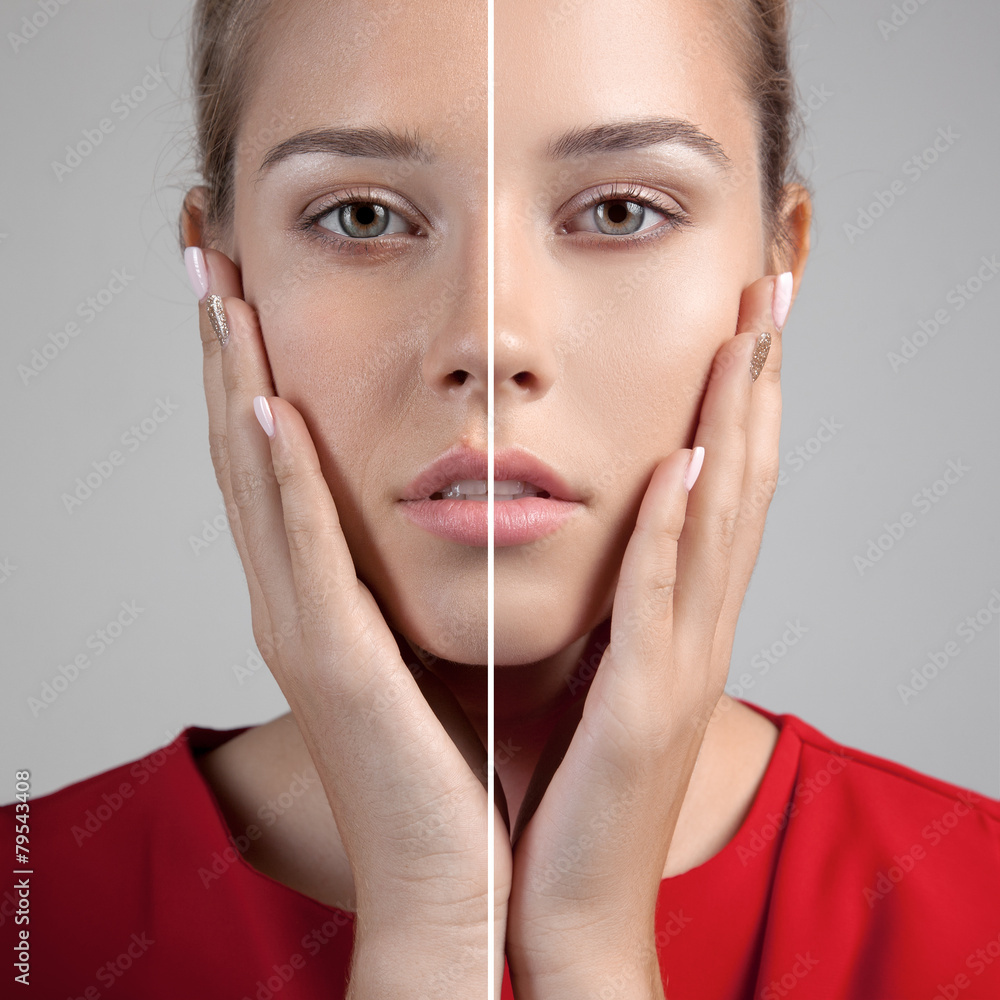 Woman with spotty skin with deep pores and blackhead and healed foto de ...