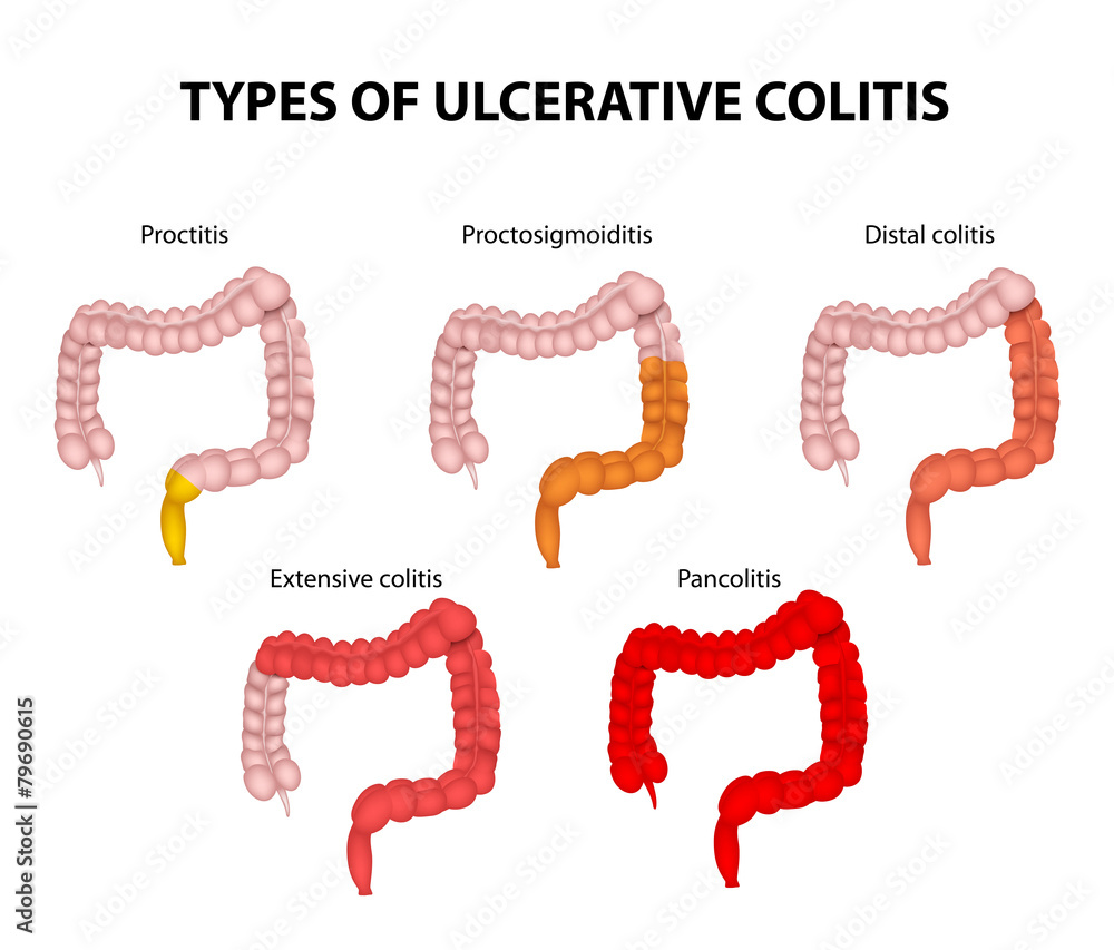 Types of Ulcerative Colitis Stock Vector | Adobe Stock