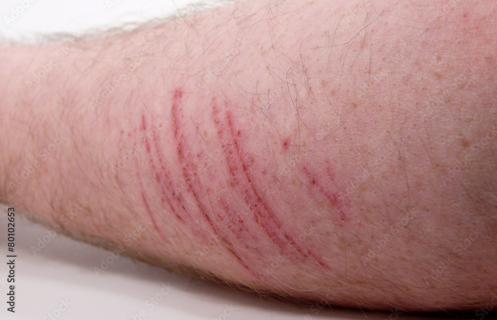 verletzter männlicher unterarm Stock-Foto | Adobe Stock