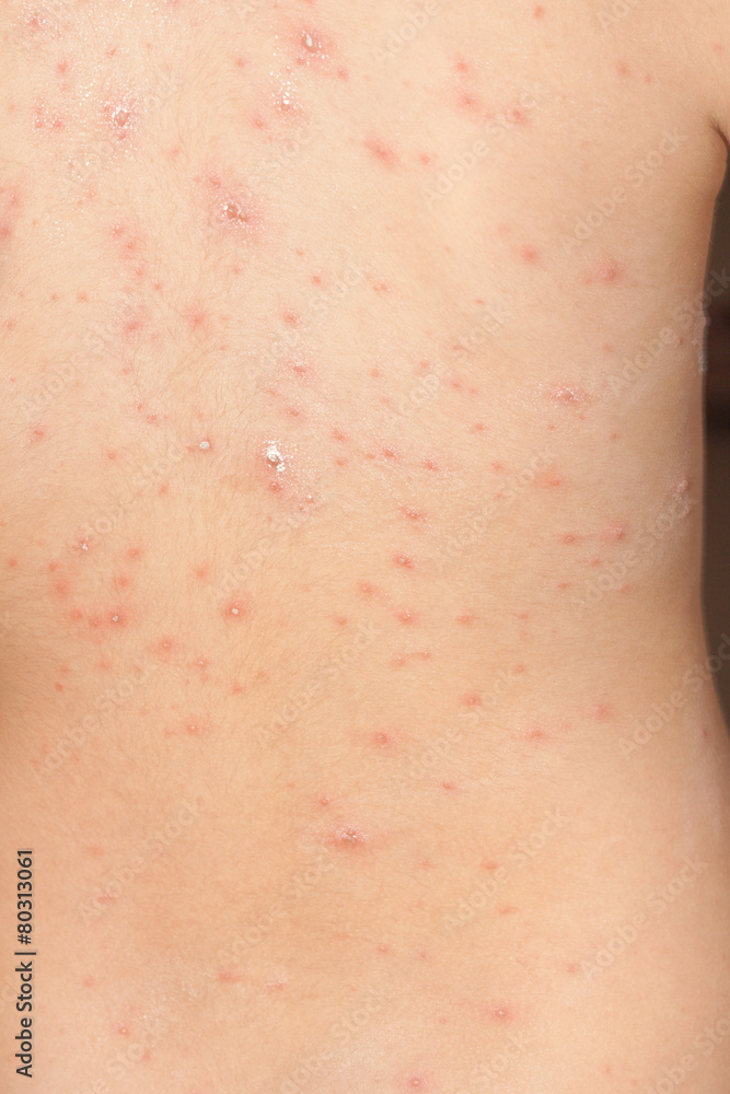 Chicken Pox Rash