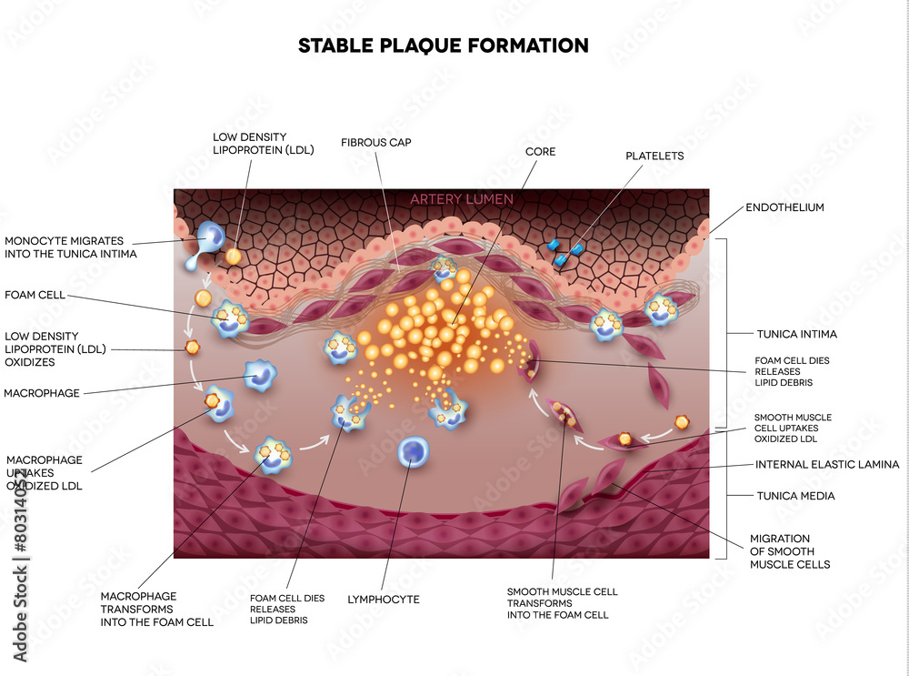 Stable plaque formation in the human artery. Atherosclerosis Stock ...