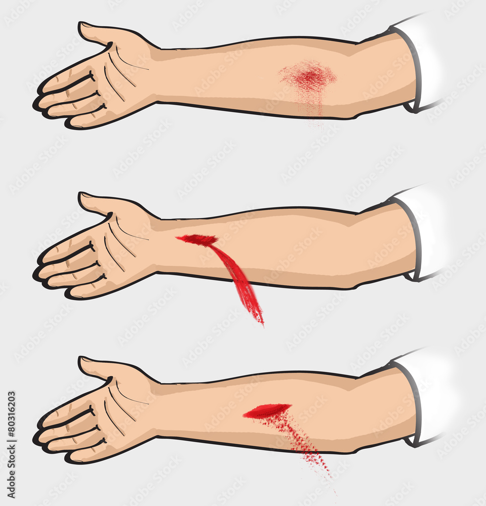 Bleeding. Types of bleeding. Classification. ilustración de Stock ...