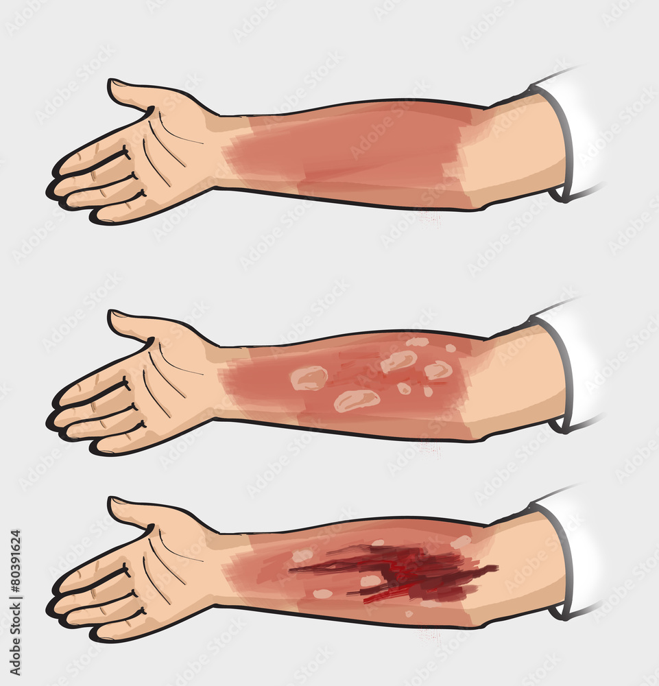 Classification of burns. Thermal injuries. Stock Illustration | Adobe Stock